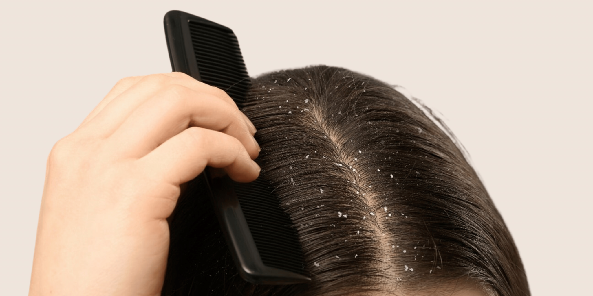 DHS Zinc Shampoo Review: How To Get An Itch And Dandruff-free Scalp